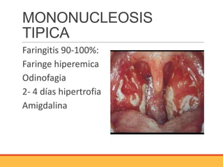 Mononucleosis infecciosa | PPTX
