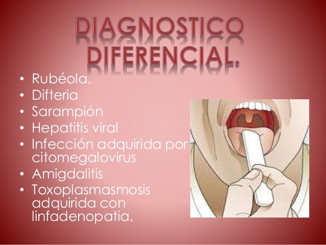 Mononucleosis infecciosa