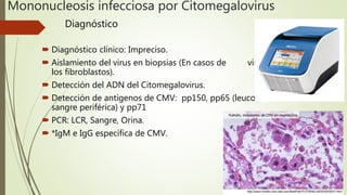 Mononucleosis infecciosa CMV | PPTX