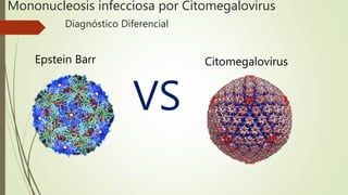 Mononucleosis infecciosa CMV | PPTX