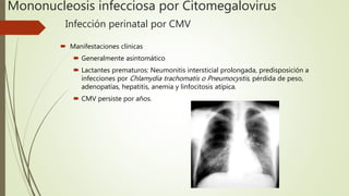 Mononucleosis infecciosa CMV | PPTX