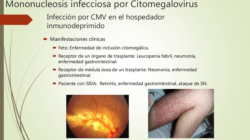 Mononucleosis infecciosa por citomegalovirus