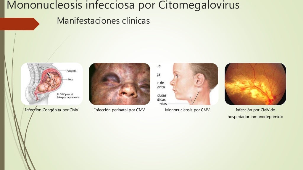 Mononucleosis infecciosa por citomegalovirus