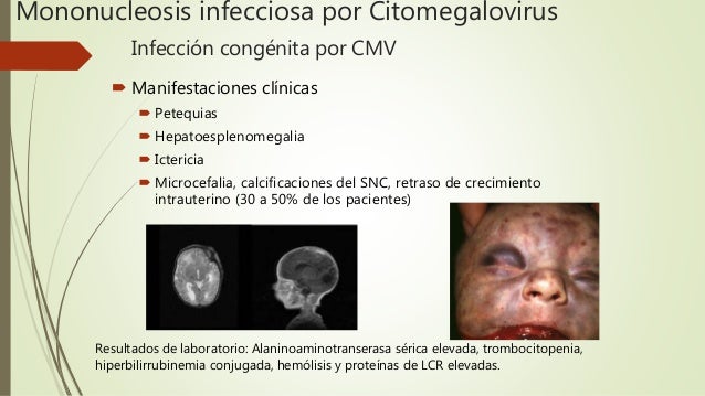 Mononucleosis infecciosa por citomegalovirus
