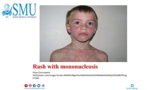 mononucleosis lecture mbbs medicine.ppt. | PPTX