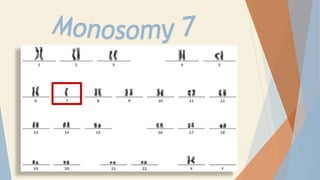 Monosomy 7 | PPTX