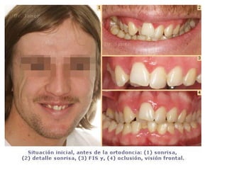 Montaje de los dientes enfilado | PDF