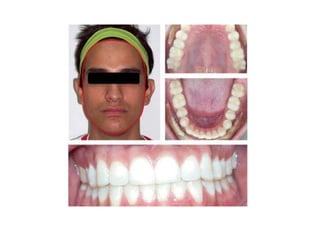 Montaje de los dientes enfilado | PDF