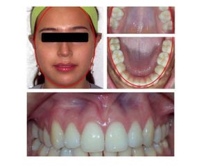 Montaje de los dientes enfilado | PDF