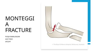 UPPER LIMB FRACTURES - MONTEGGIA FRACTURE | PPTX