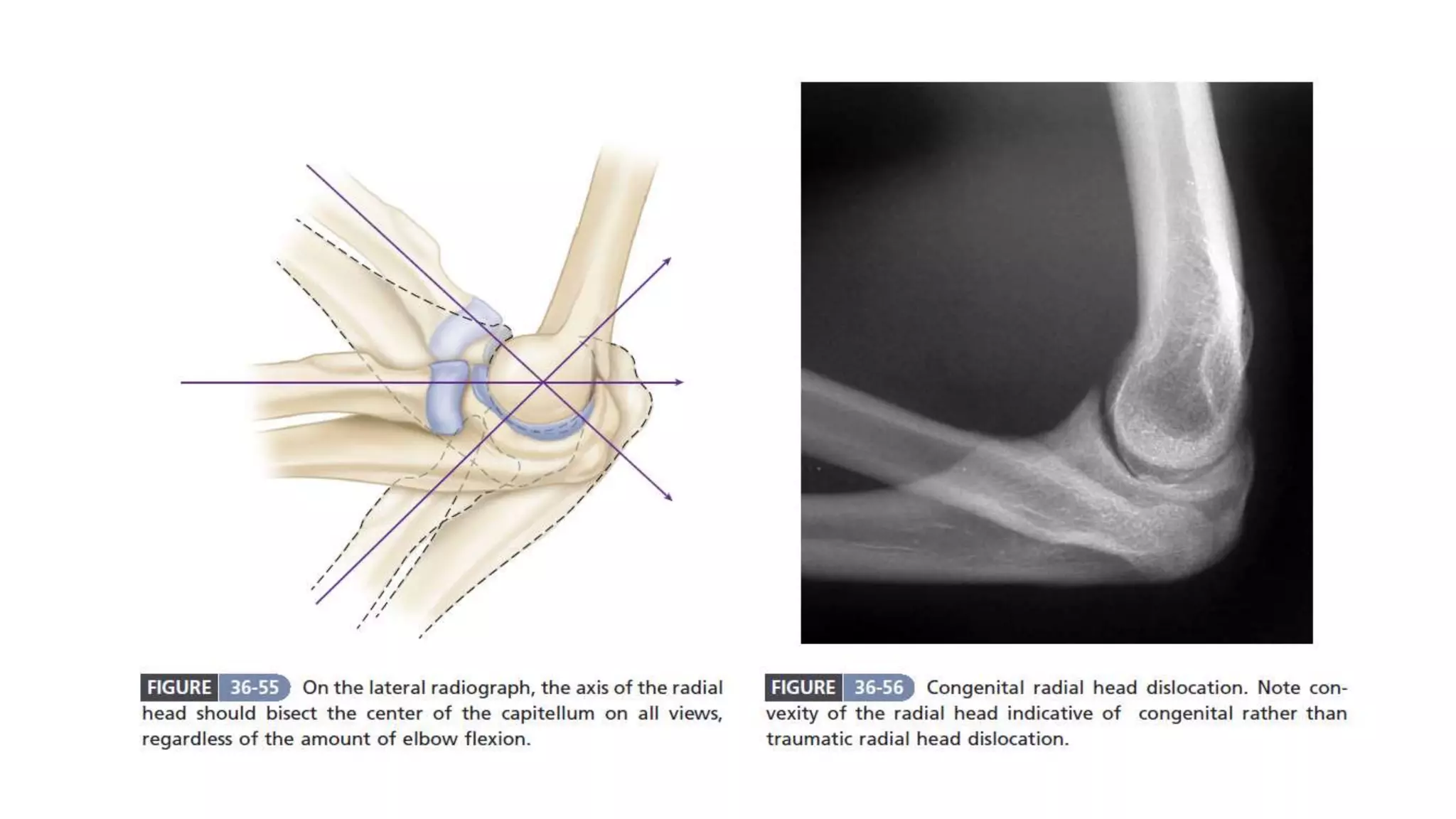 Monteggia fracture dislocation | PPTX
