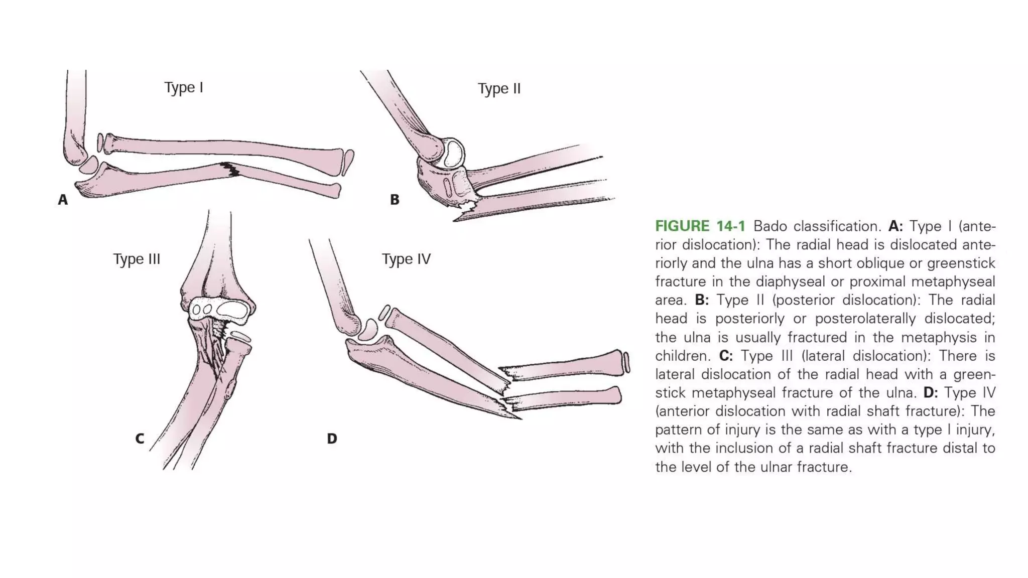 Monteggia fracture dislocation | PPTX