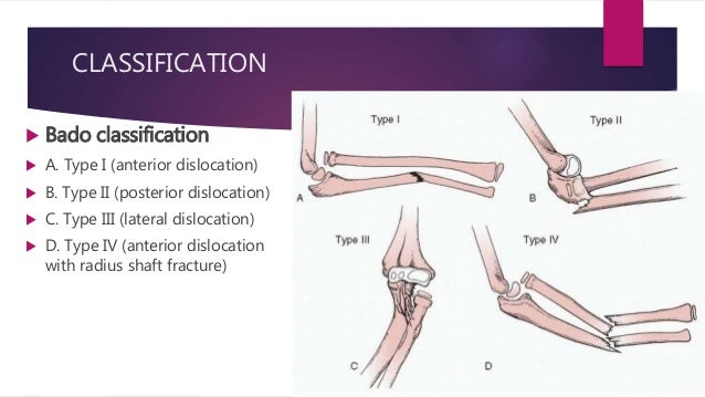 Monteggia fracture dislocation in chldren