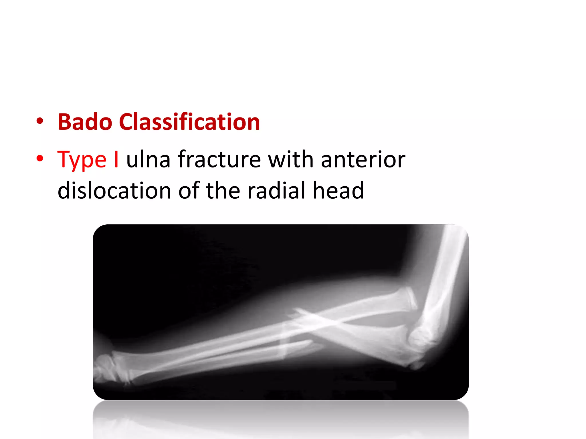 Monteggia fracture in children | PPTX | Bone and Joint Conditions ...