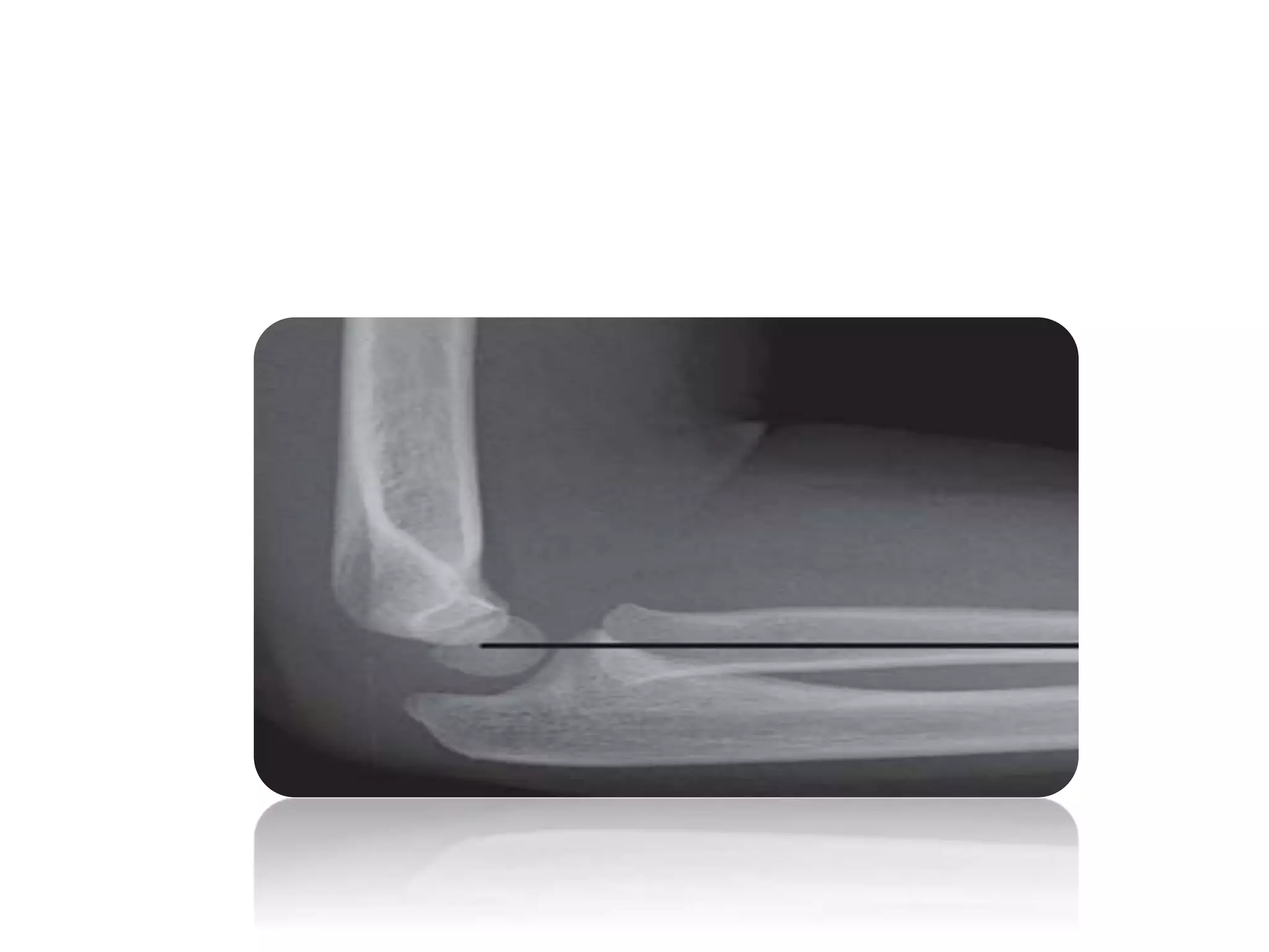 Monteggia fracture in children | PPTX