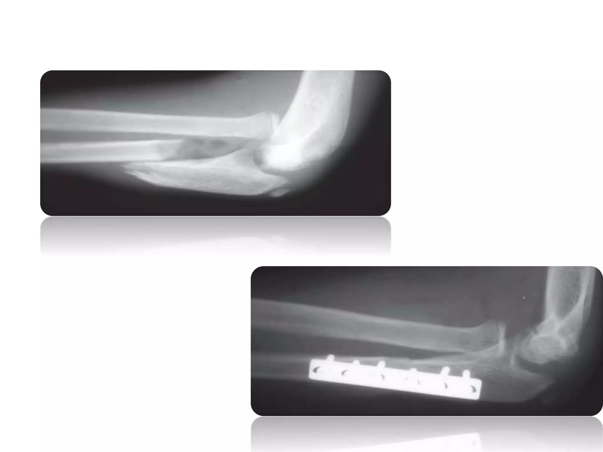 Monteggia fracture in children | PPTX