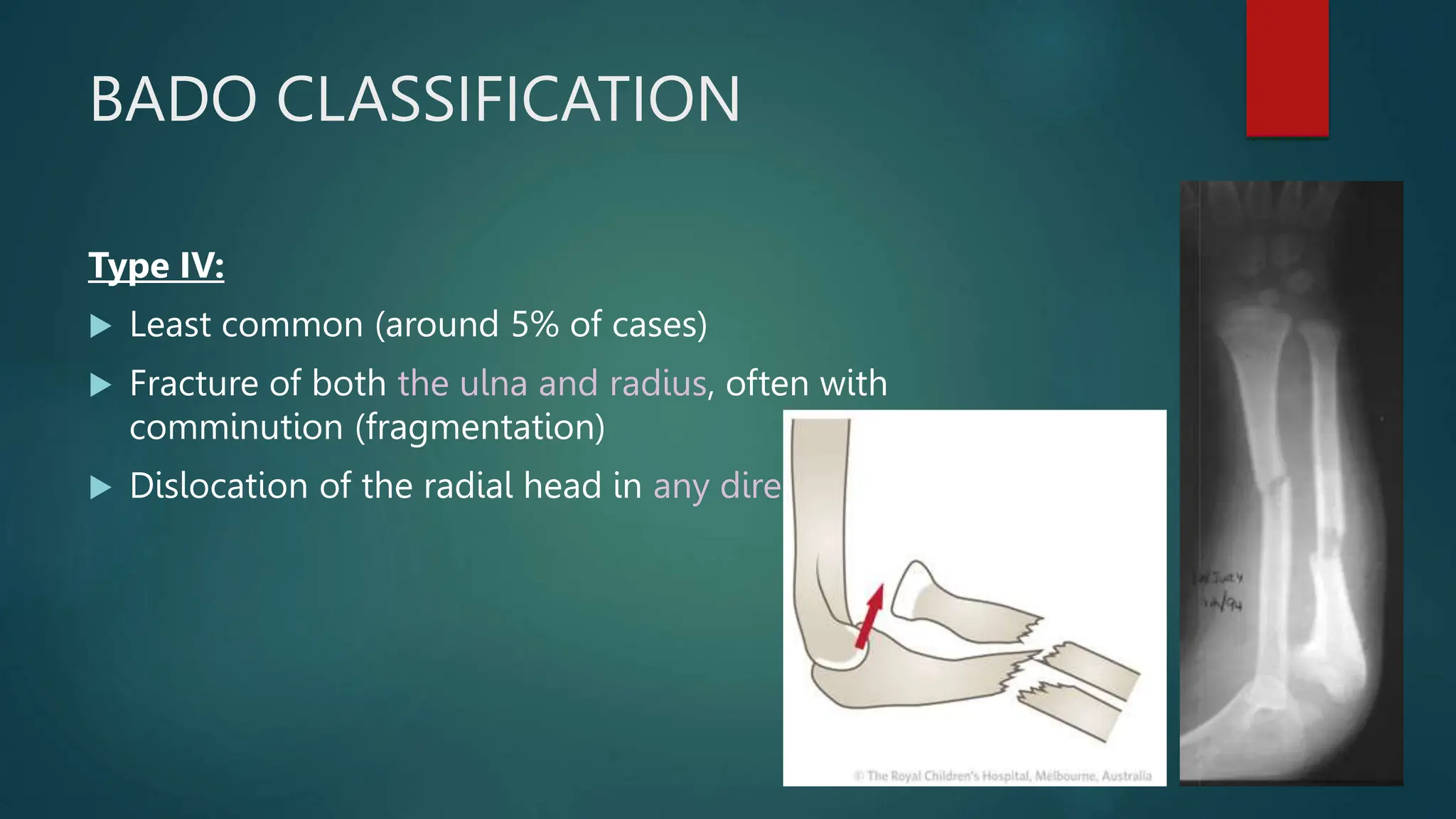 MONTEGGIA FRACTURES CLASSIFICATIONS.pptx