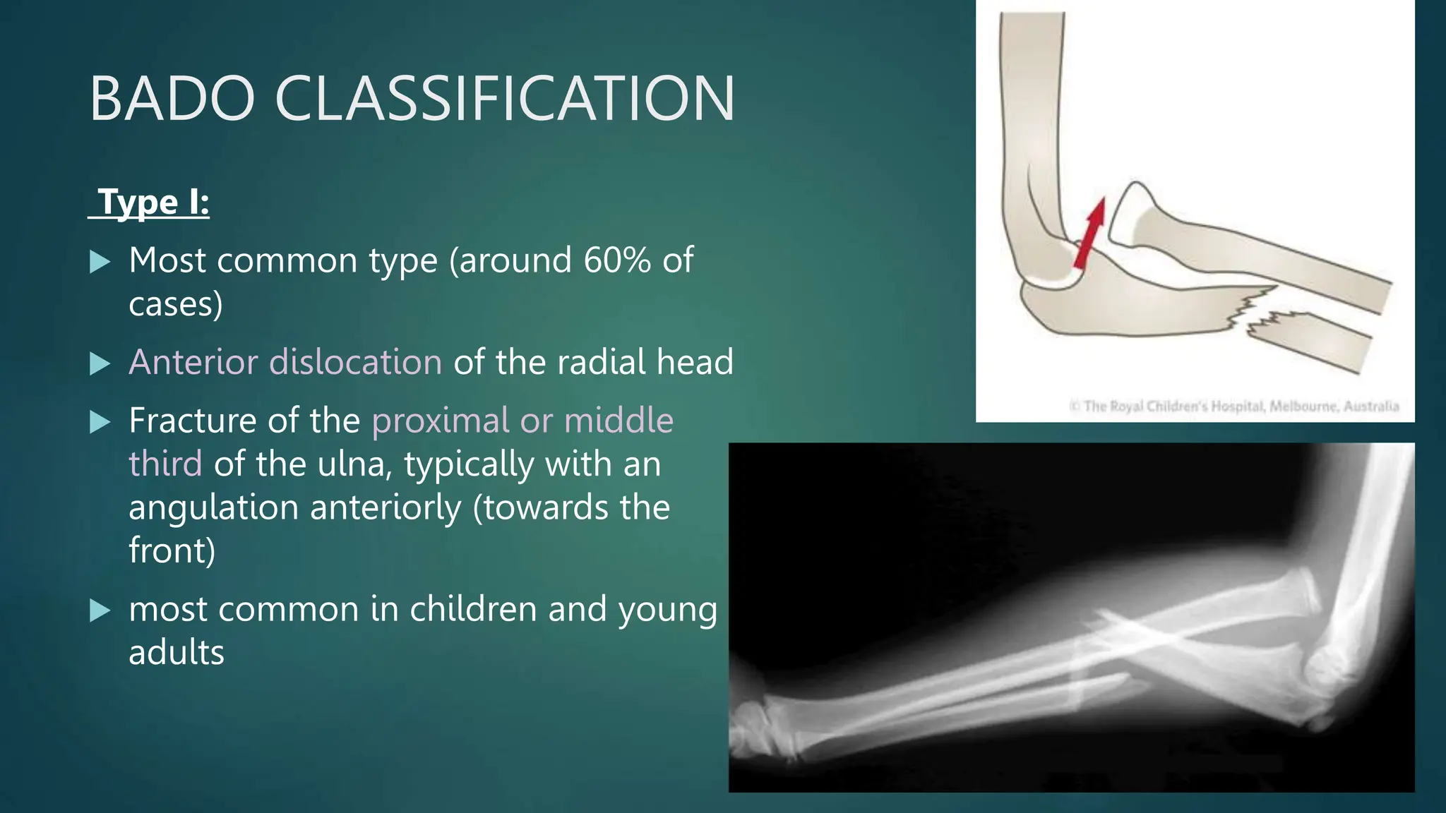 MONTEGGIA FRACTURES CLASSIFICATIONS.pptx