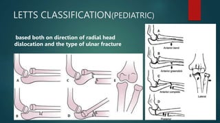 MONTEGGIA FRACTURES CLASSIFICATIONS.pptx