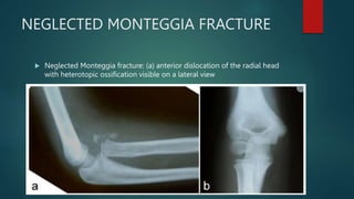 MONTEGGIA FRACTURES CLASSIFICATIONS.pptx