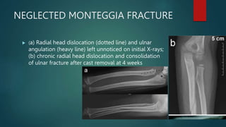 MONTEGGIA FRACTURES CLASSIFICATIONS.pptx