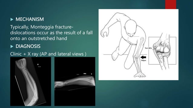 MONTEGGIA FRACTURES CLASSIFICATIONS.pptx | Death, Injury, or Military ...