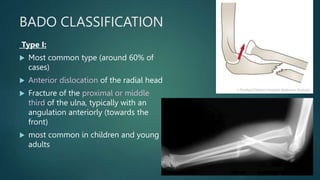 MONTEGGIA FRACTURES CLASSIFICATIONS.pptx