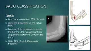 MONTEGGIA FRACTURES CLASSIFICATIONS.pptx