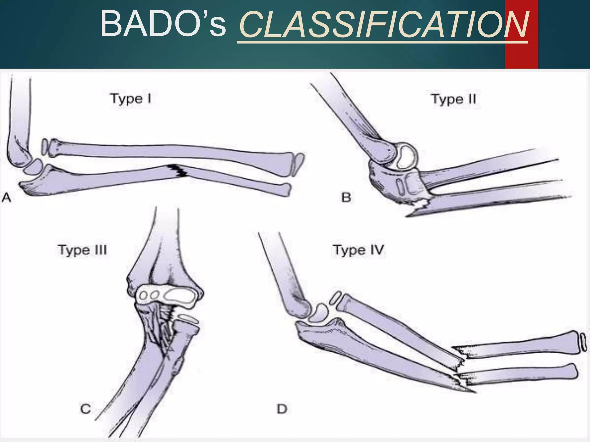 Monteggia fracture-Dislocation reference-appleys,maheshwari,rockwood | PPTX