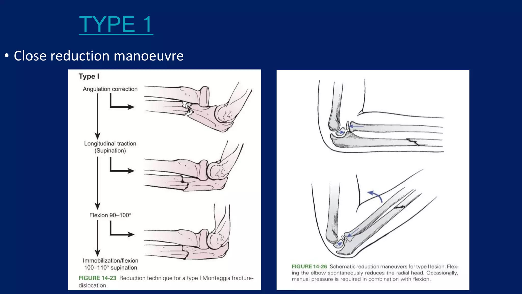 Monteggia fracture dislocation.pptx