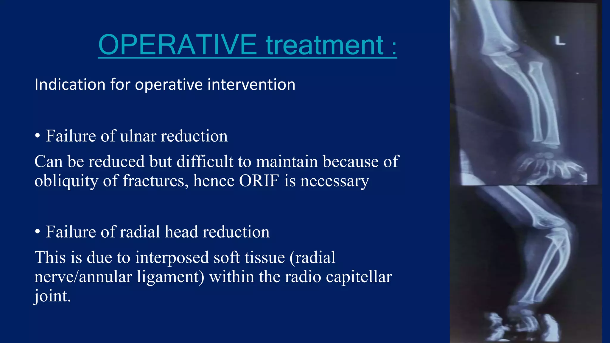 Monteggia fracture dislocation.pptx