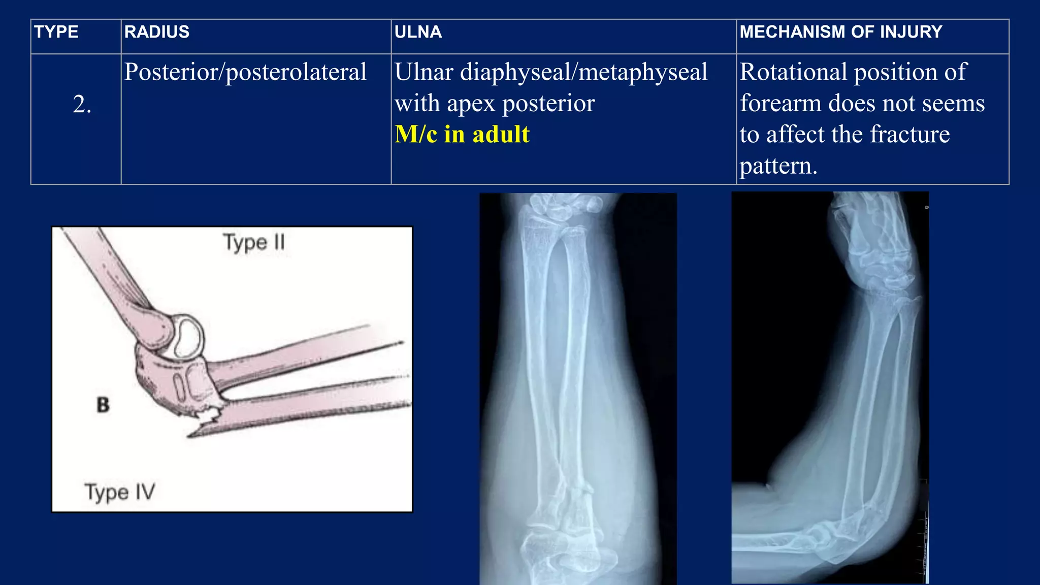 Monteggia fracture dislocation.pptx