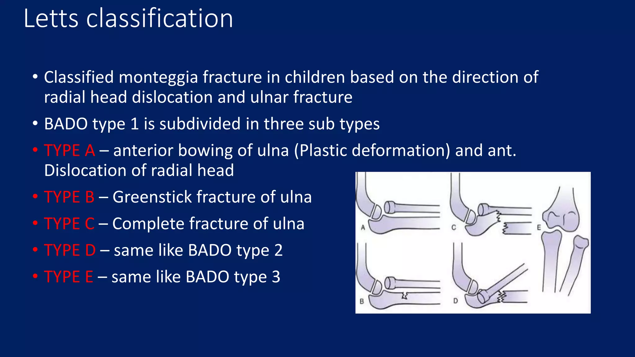 Monteggia fracture dislocation.pptx