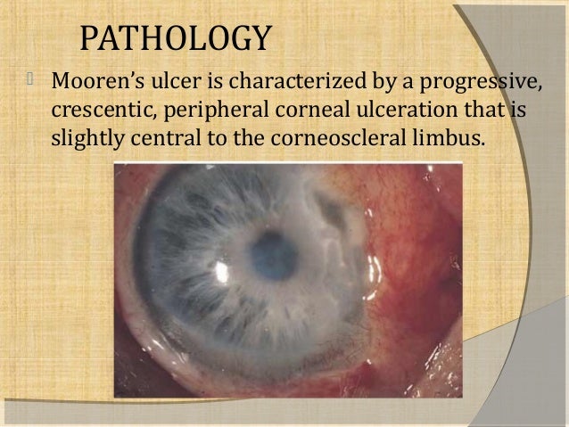 Mooren’s ulcer