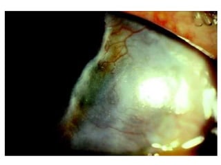 Mooren’s ulcer | PPTX