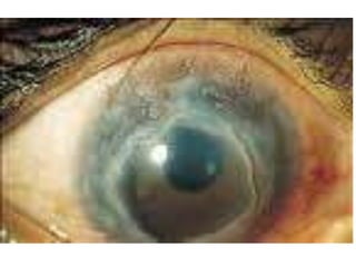 Mooren’s ulcer | PPTX