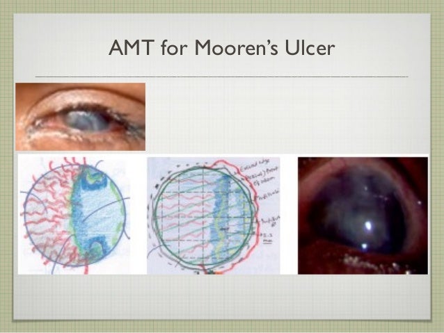 Mooren’s Ulcer