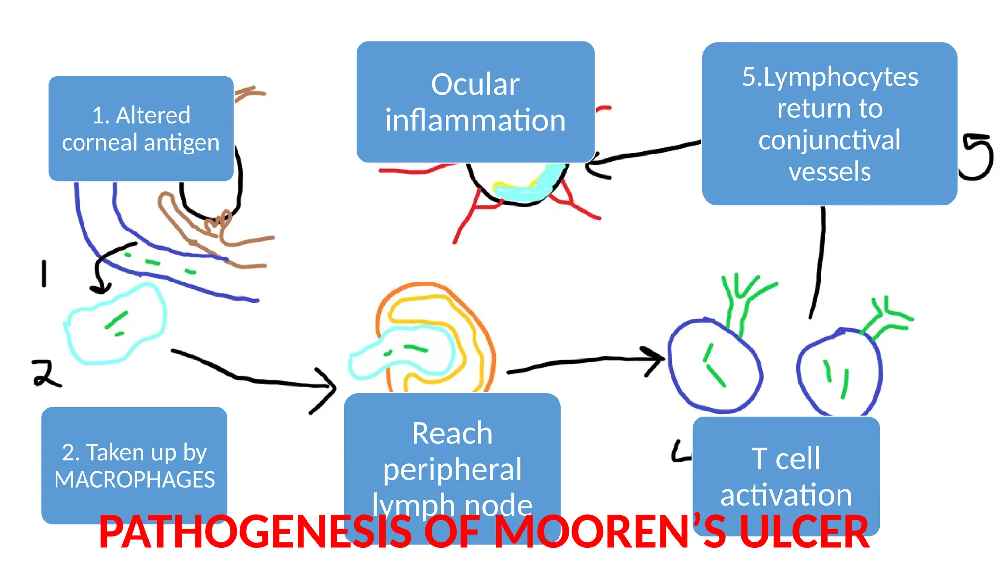 MOOREN’S ULCER of cornea first final ppt.pptx