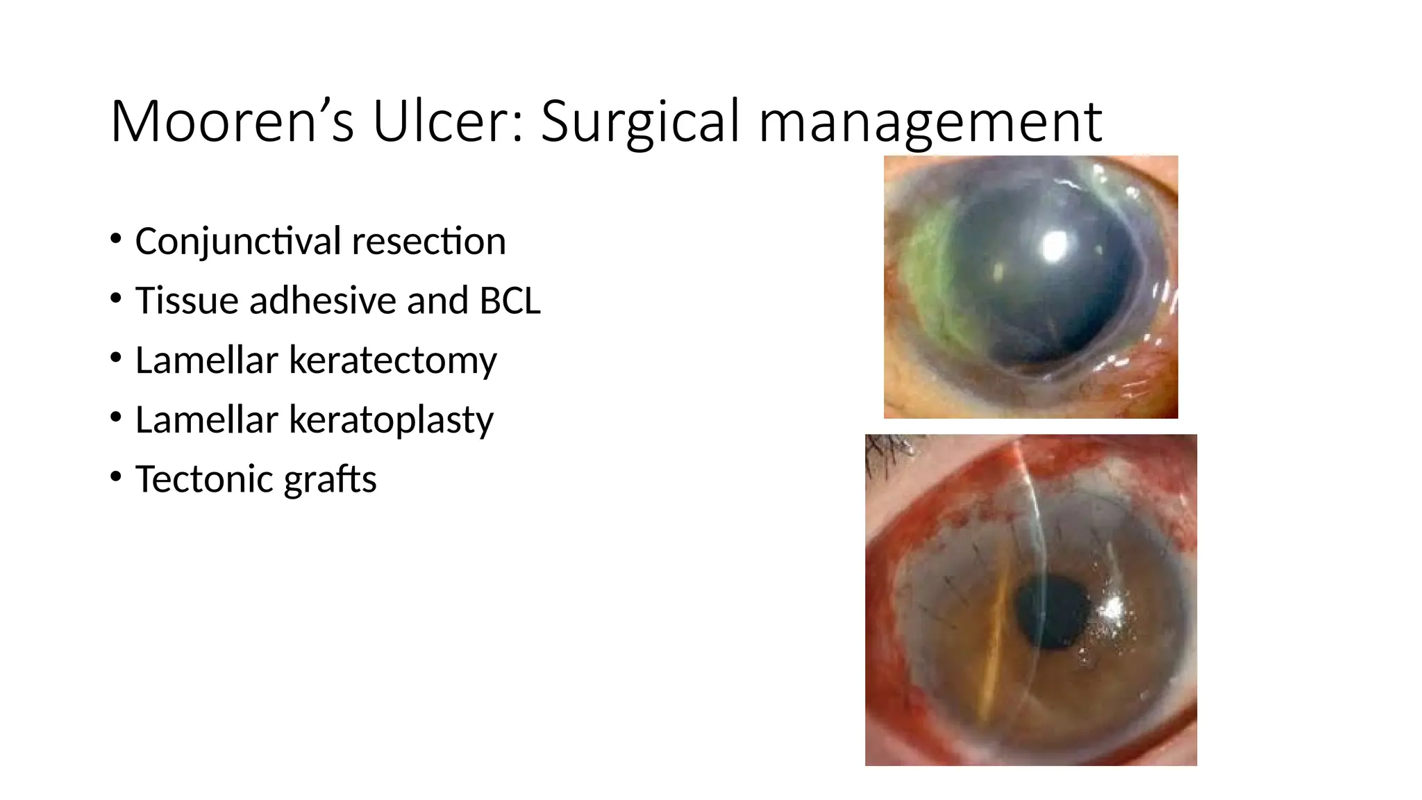 MOOREN’S ULCER of cornea first final ppt.pptx