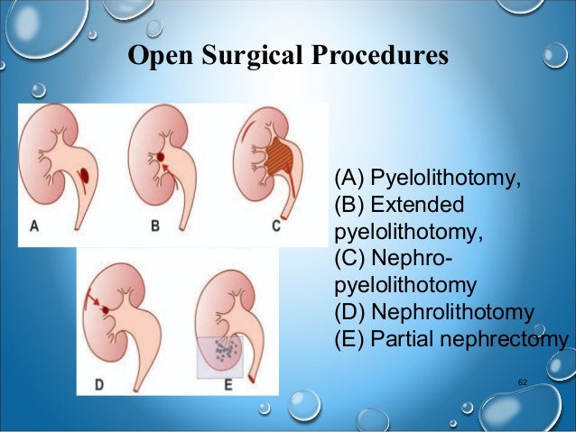 Mootrashmari wsr to urolithiasis