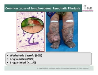 Morbidity Management and Disability Prevention of Lymphatic Filariasis ...