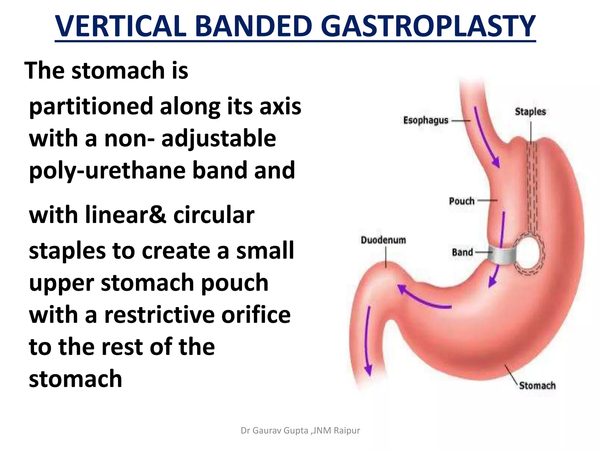 Morbid obesity and surgical management | PPTX