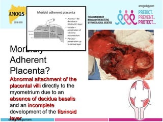 Morbid placenta preventation management prediction | PPT