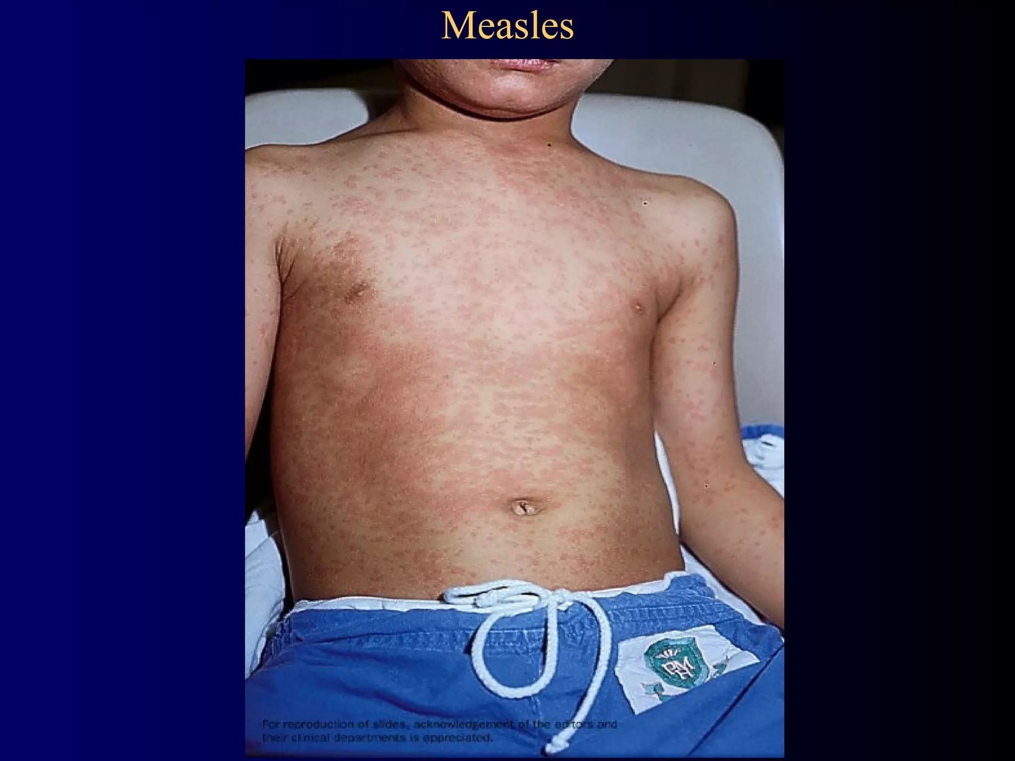MEASLES | PPT