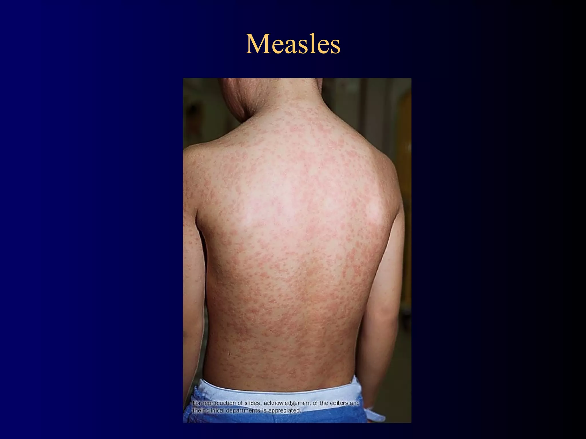 MEASLES | PPT