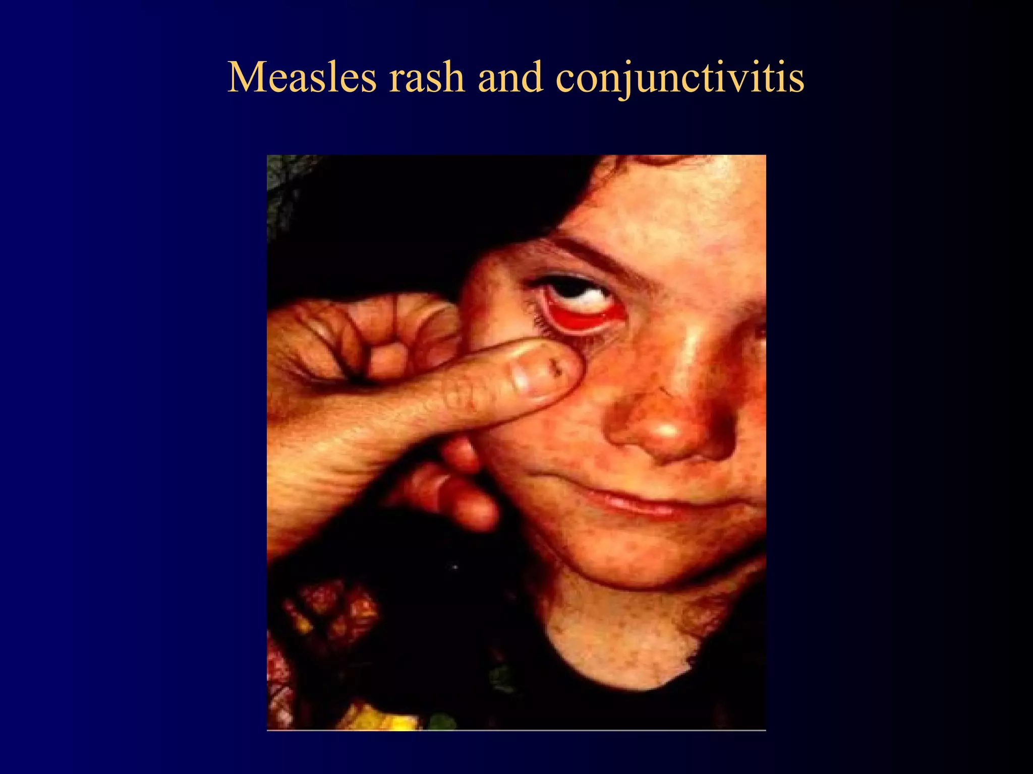 MEASLES | PPT