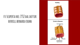 Morbo di crohn, Matilde Migliosi e Alice Signorini | PPTX | Digestive ...
