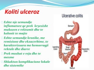 Morbus crohn dhe koliti ulceroz,, | PPTX