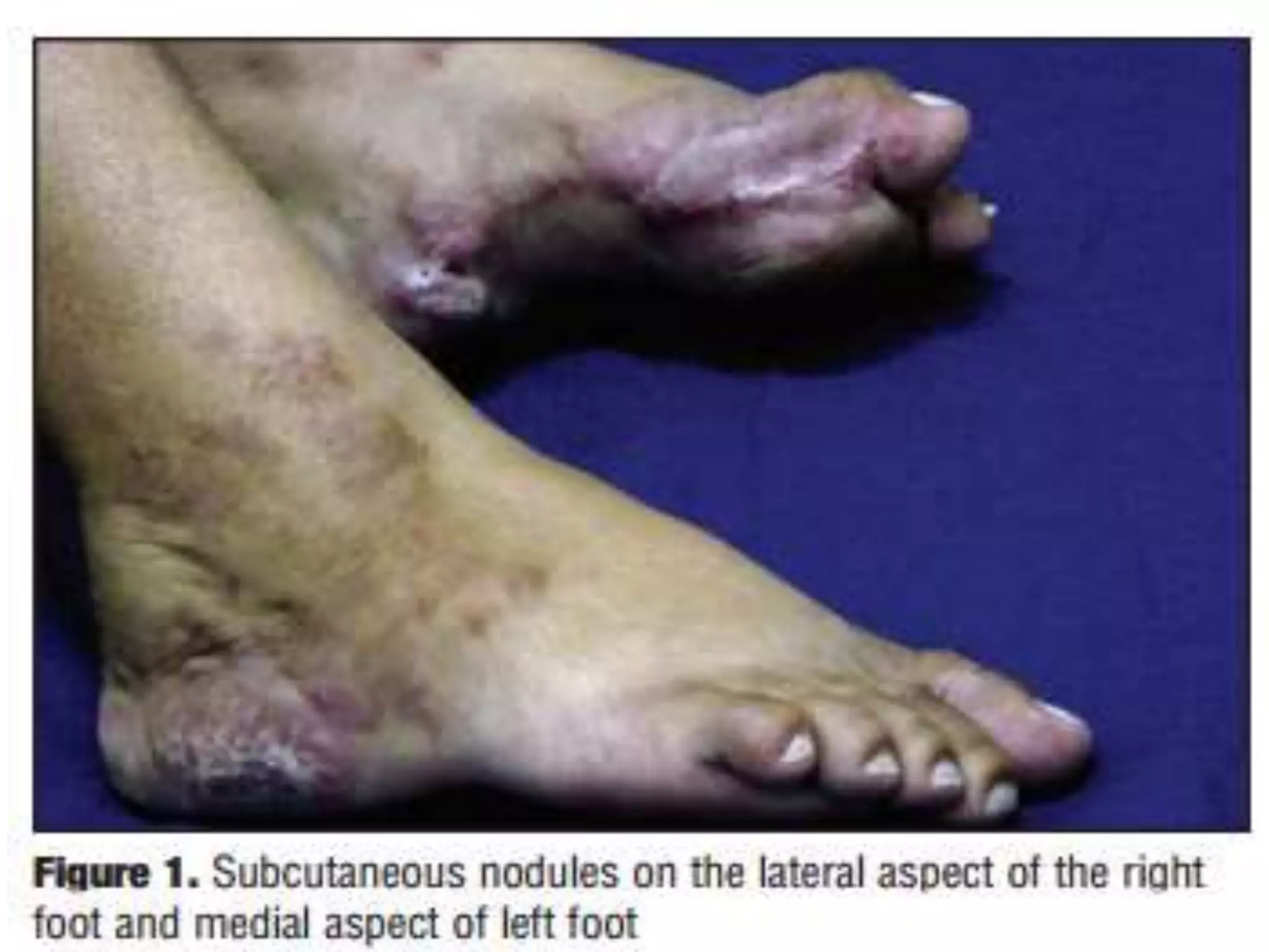 Morbus ladderhose disease | PPTX