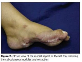 Morbus ladderhose disease | PPTX